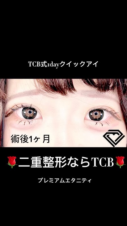 【二重整形】TCB式1dayクイックアイ（二重埋没法）プレミアムエタニティ🌹術後1ヶ月 #shorts #TCB #二重整形 #二重埋没 - YouTube