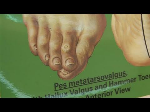 How To Treat Overlapping Toes - YouTube