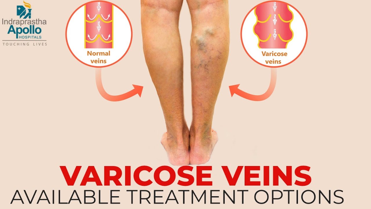 Varicose Veins Available Treatment Options | Dr. Rakesh Mahajan ...