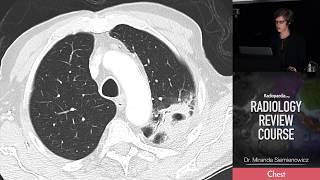 Necrotizing Pneumonia Radiology