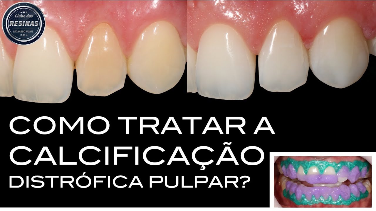 Como tratar a calcificação distrófica pulpar? - YouTube