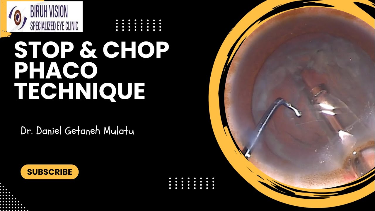 Stop and Chop Phaco Technique for Soft Cataract - YouTube