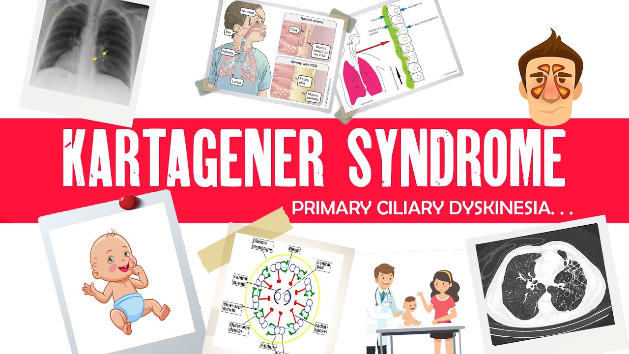 Kartagener syndrome| Primary Ciliary Dyskinesia| Immotile cilia ...
