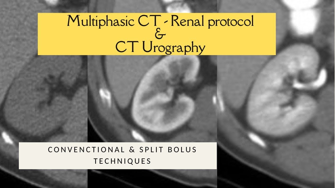 MULTIPHASIC RENAL CECT PROTOCOL + SPLIT BOLUS TECHNIQUE. CT UROGRAPHY ...