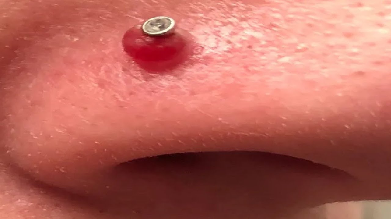 easy way to get rid of a piercing bump at home - YouTube