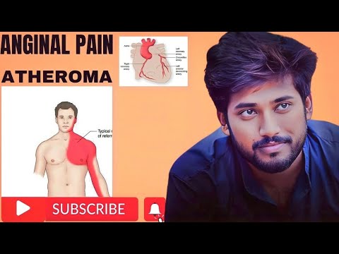 Angina/ chest pain ,Radiation,cause,exact symptom of Anginal pain ...