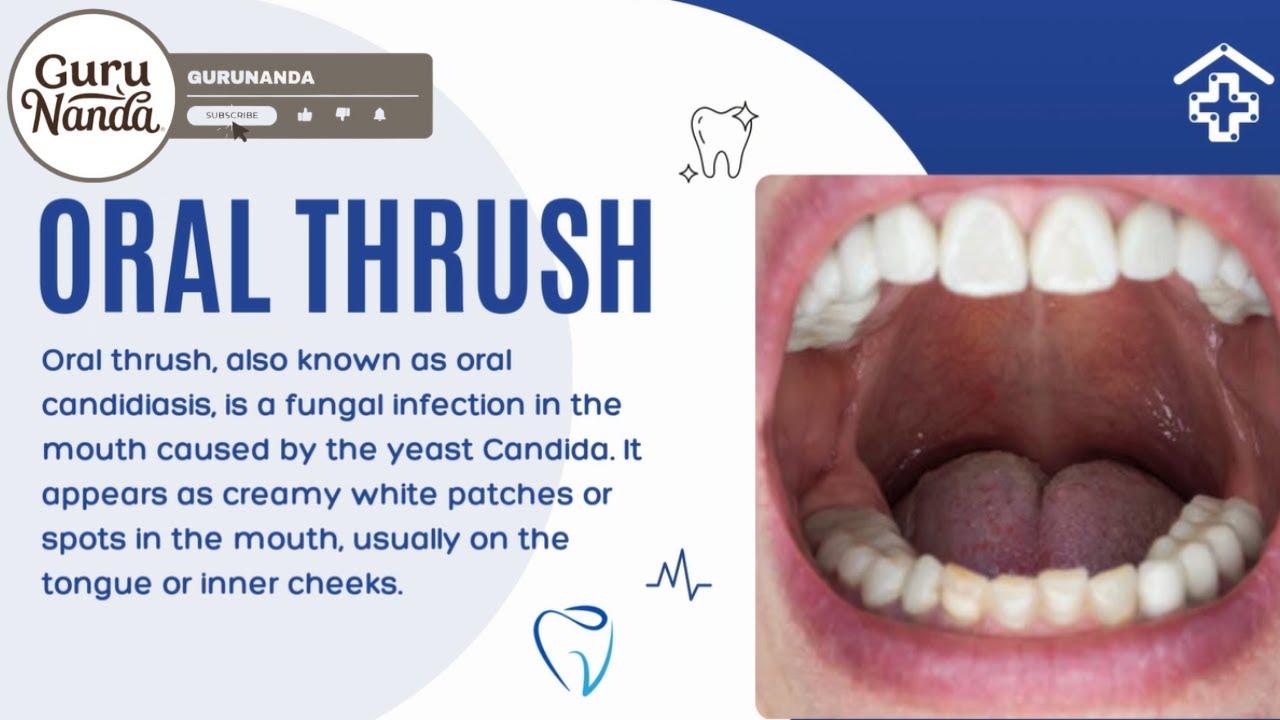 Oral Thrush Prevention! - YouTube