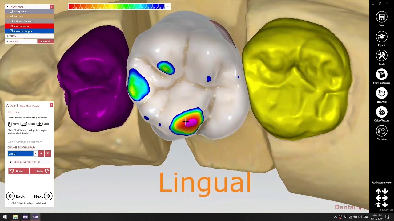 Exocad (7)single crown design - YouTube