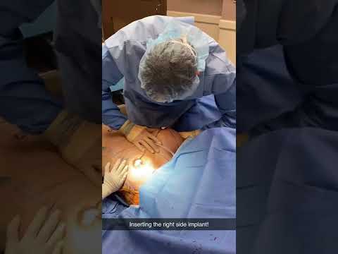 HUGE Transformation! Transgender 650cc Breast Augmentation & BBL In One ...