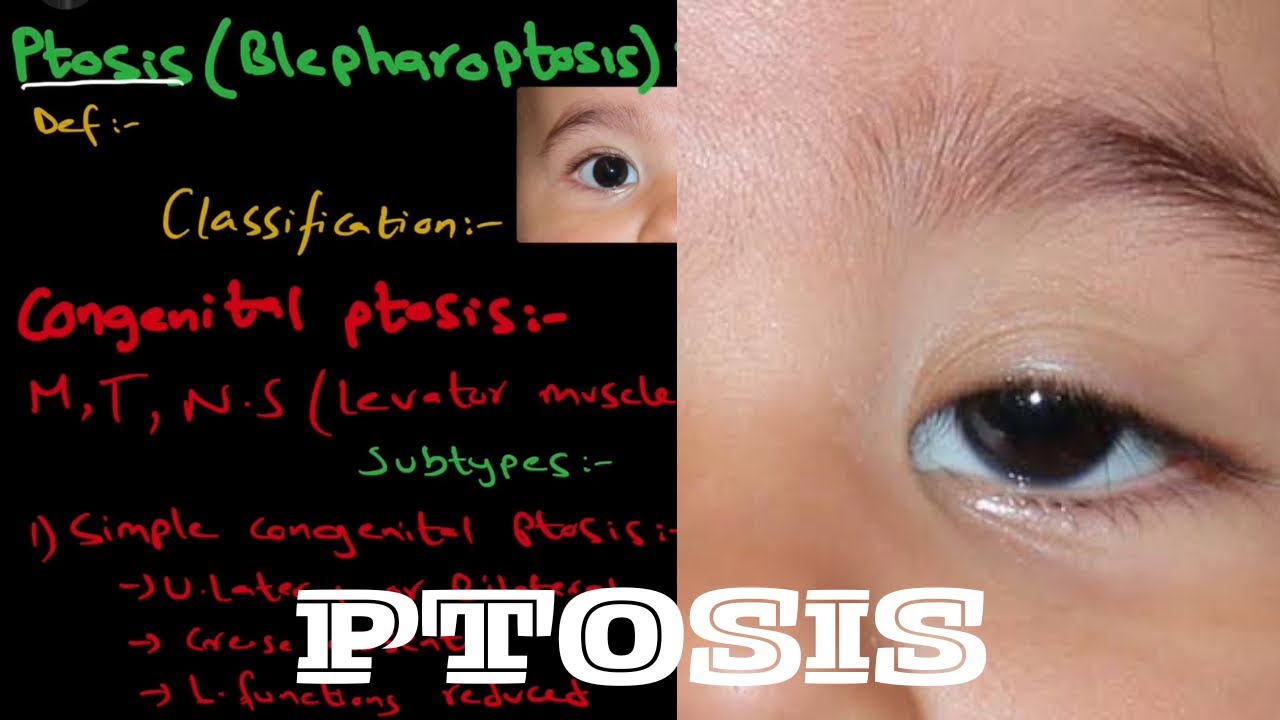 What is Ptosis ? Droopy eyelid ? , it’s types and treatment , detailed ...