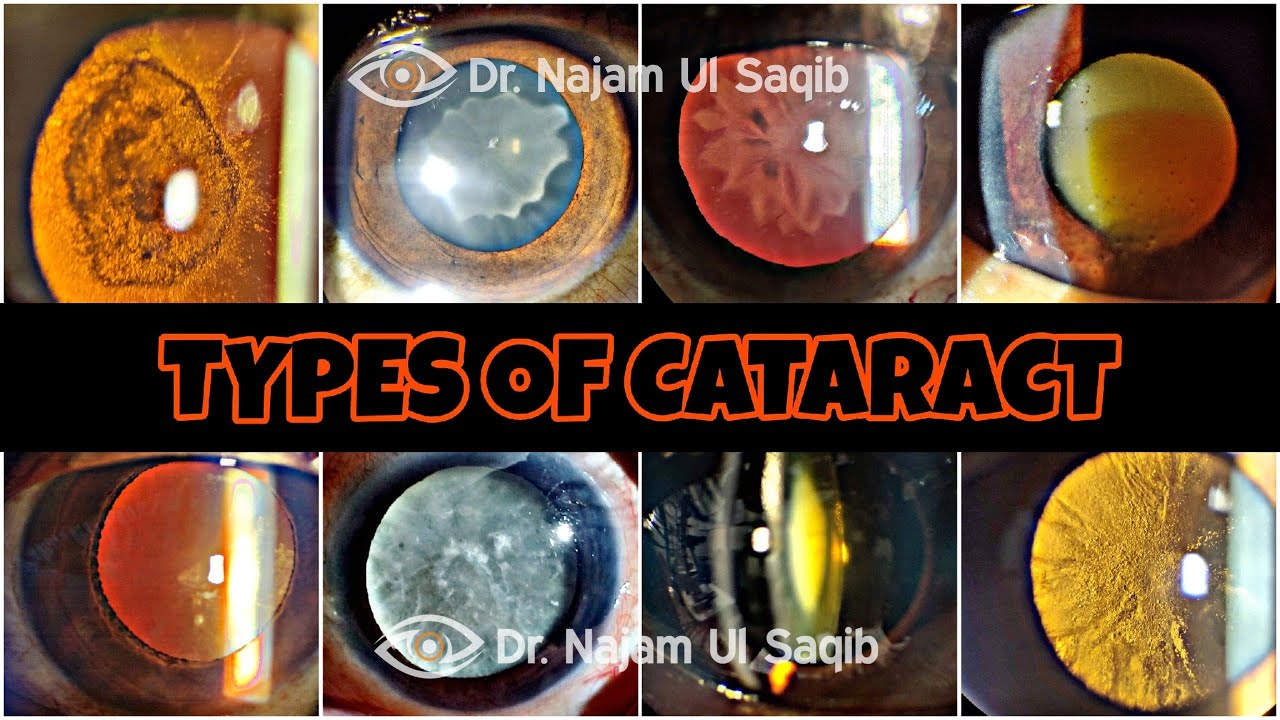 Types Of Cataract - YouTube