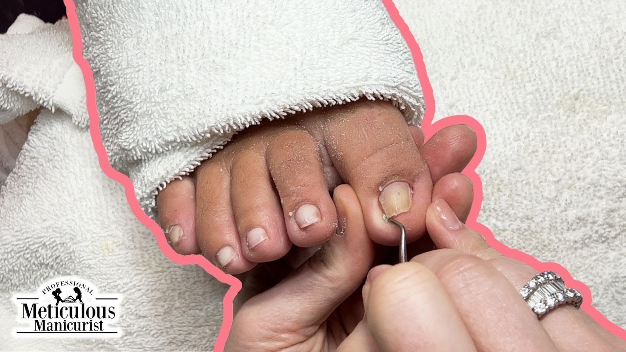 How to Fix a Folded and Tented Toenail with Pedicures - YouTube