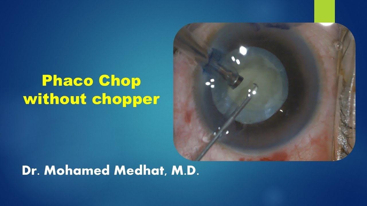 Phacoemulsification : Chop without Chopper - YouTube
