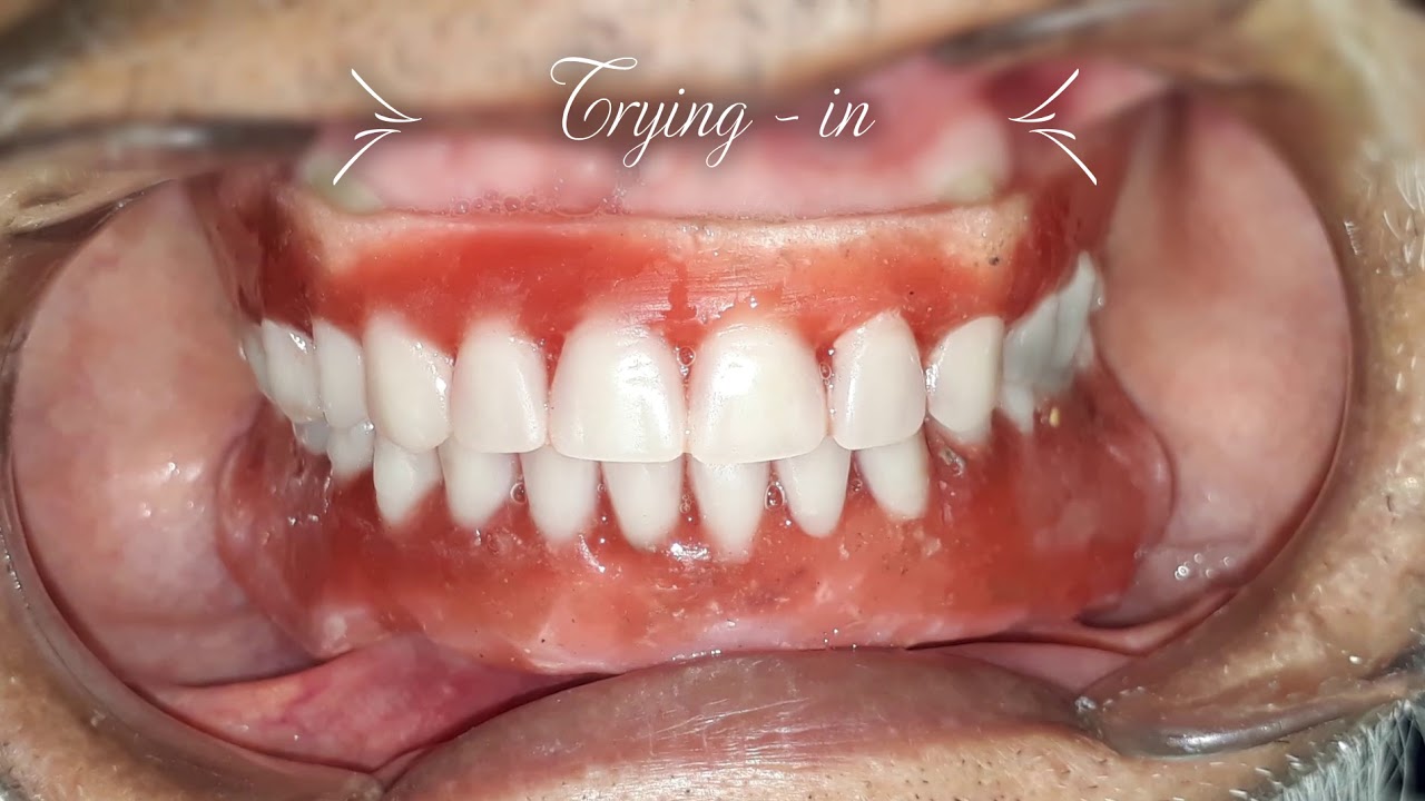 Flangeless Denture - YouTube