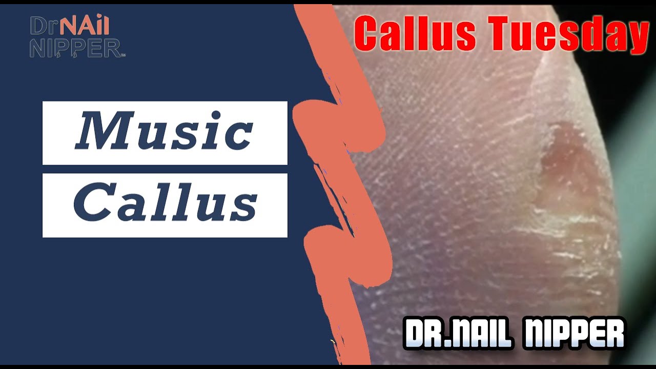 Do you Enjoy Music with a Callus? (2020) - YouTube