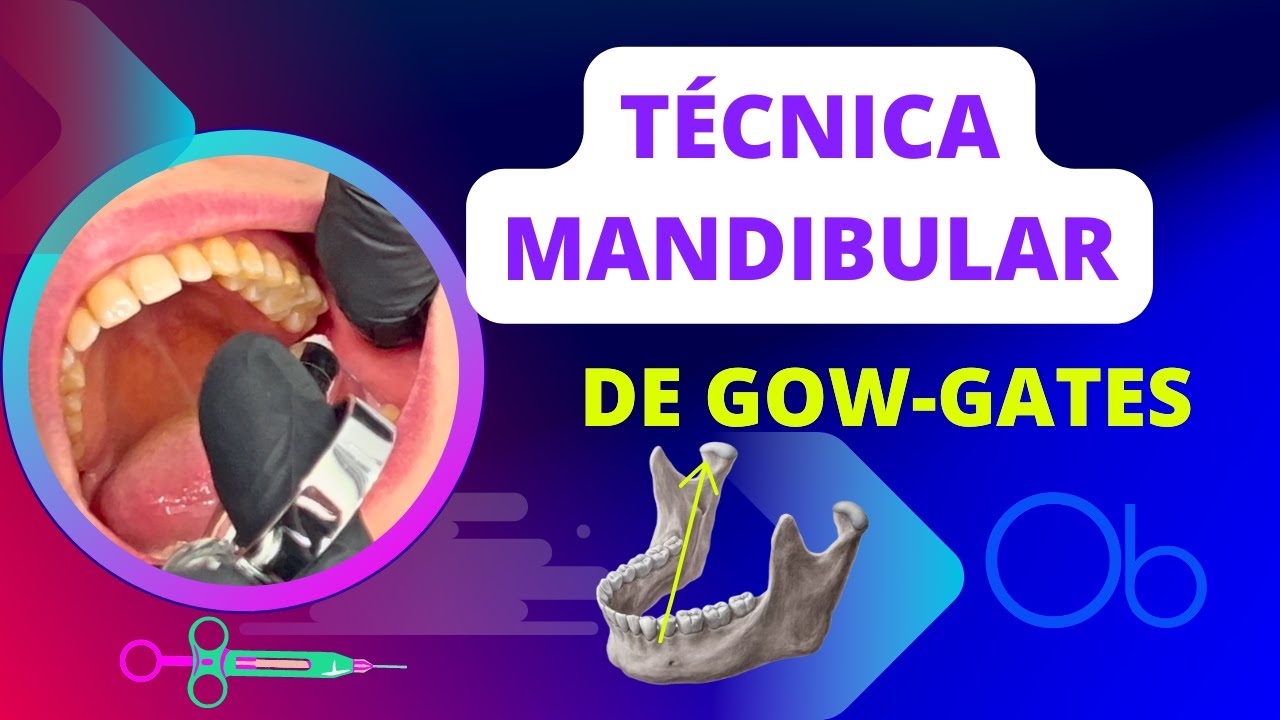 Técnica Mandibular de Gow-Gates - YouTube