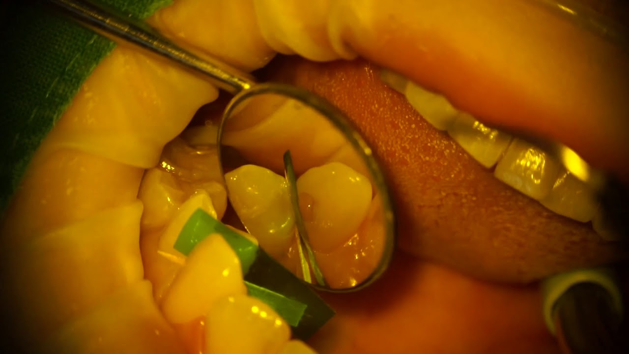 class III resin filling - YouTube