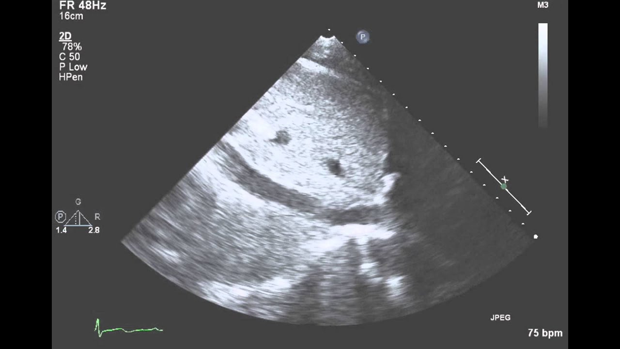TTE Normal Subcostal IVC FULLCOLLAPSE Example 1 - YouTube