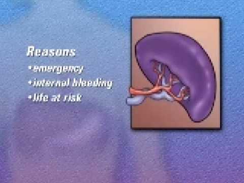 Malpractice Medical Spleen Removal Laparoscopic Splenectomy Surgery 1 ...