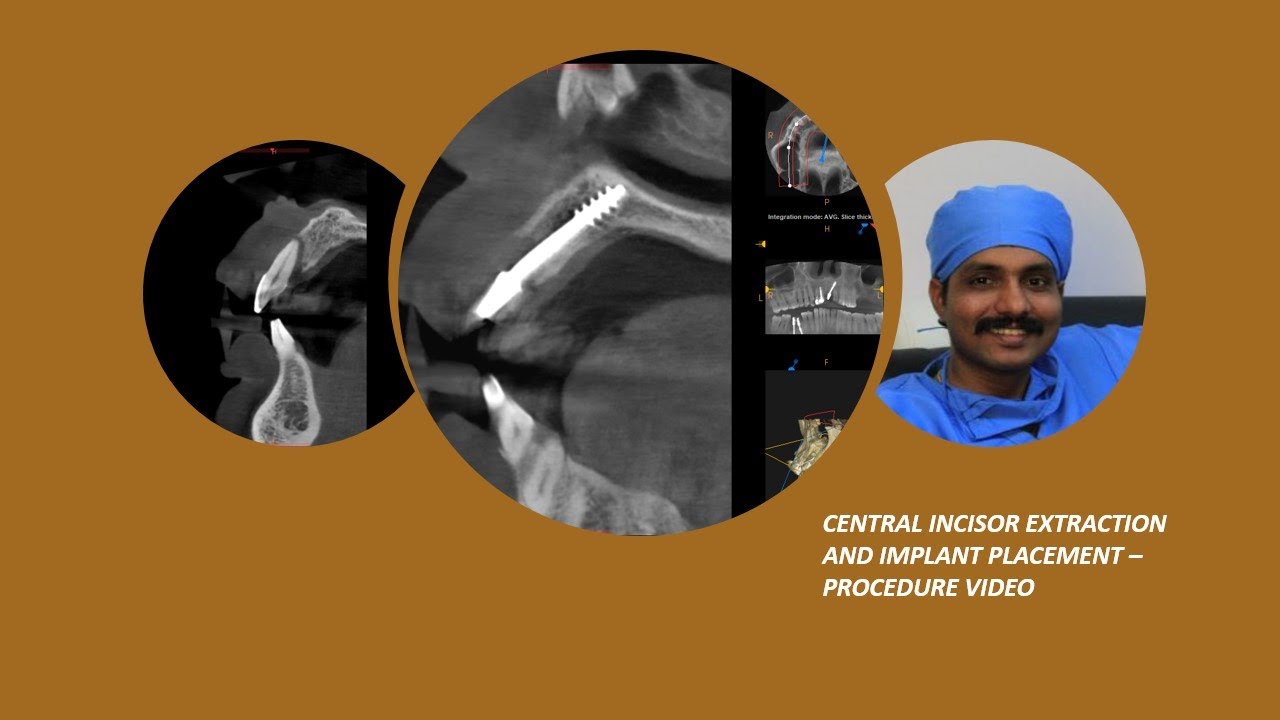 CENTRAL INCISOR EXTRACTION WITH IMPLANT PLACEMENT - PROCEDURE VIDEO ...