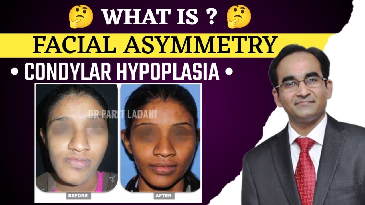 Facial Asymmetry caused by Condylar Hypoplasia Explained by Dr Parit ...