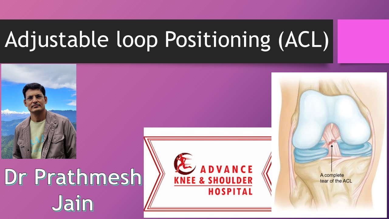 Adjustable loop flipping under vision (arthroscopy ) to confirm perfect ...