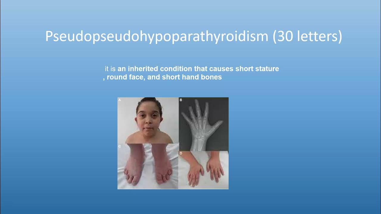 Fourth Longest Word Meaning Learn Easily In One Minute Pseudopseudohypoparathyroidism Youtube