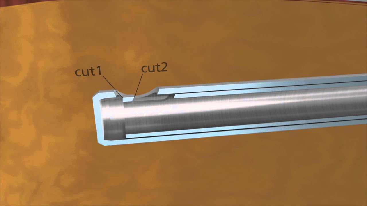 Functioning of a double blade vitreous cutter (TDC) (animation film ...