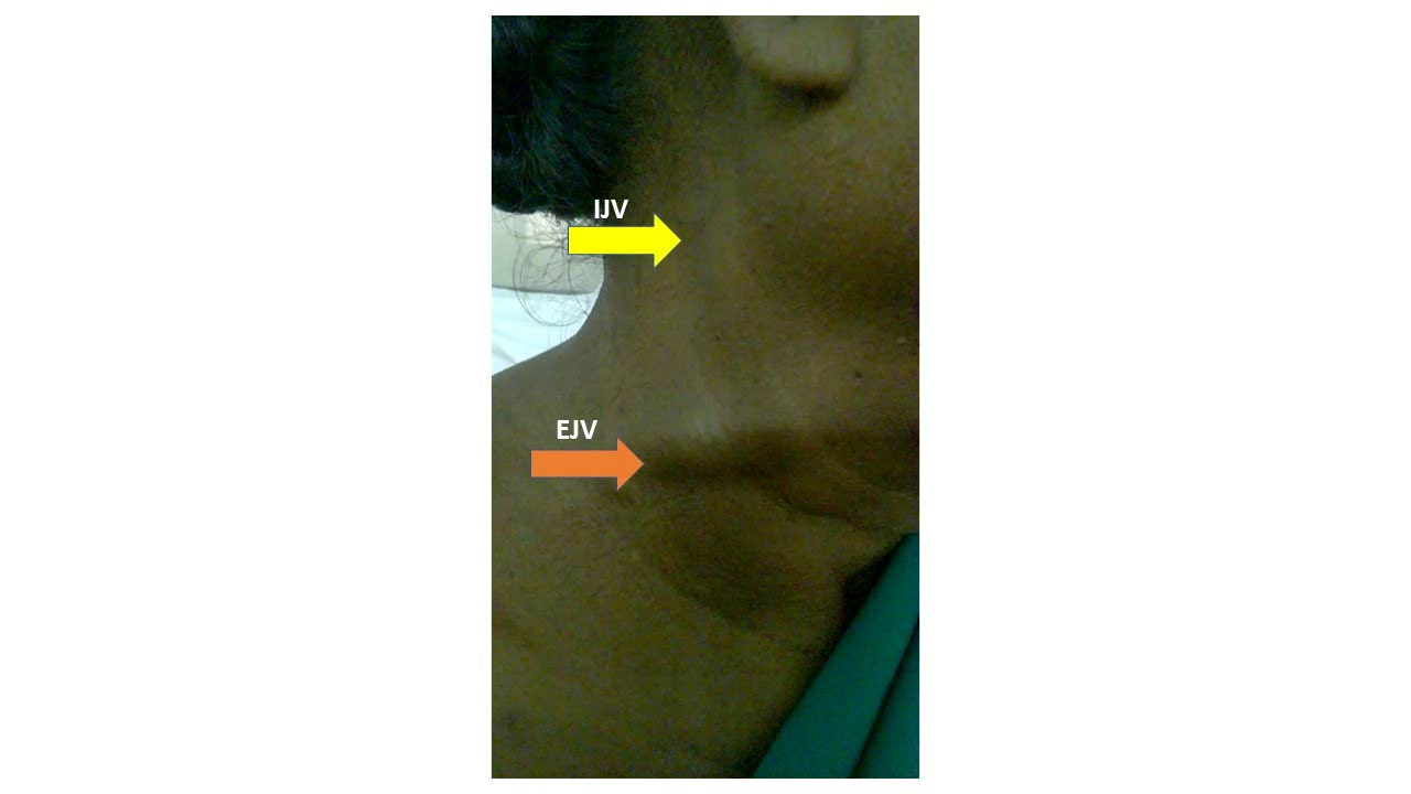 External and Internal Jugular vein pulsations - YouTube