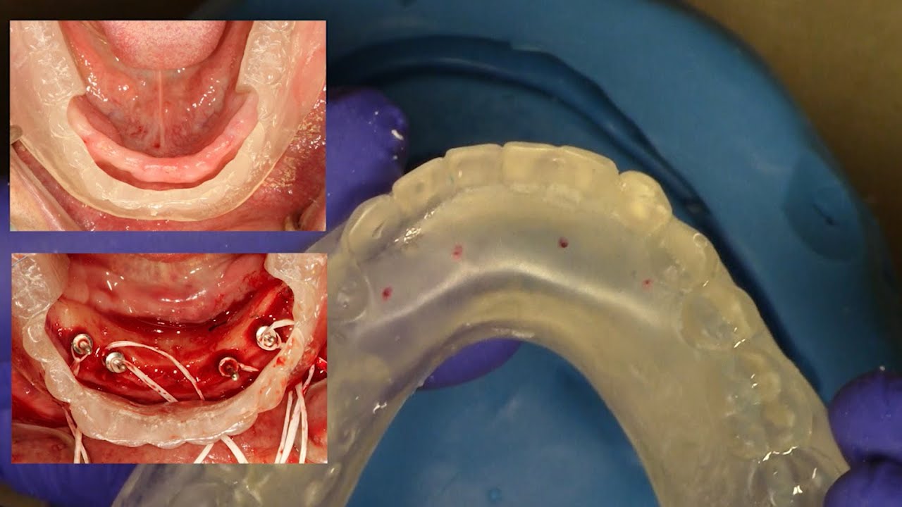 Easy Clinical & Laboratory Technique for Fabricating an "In-House ...