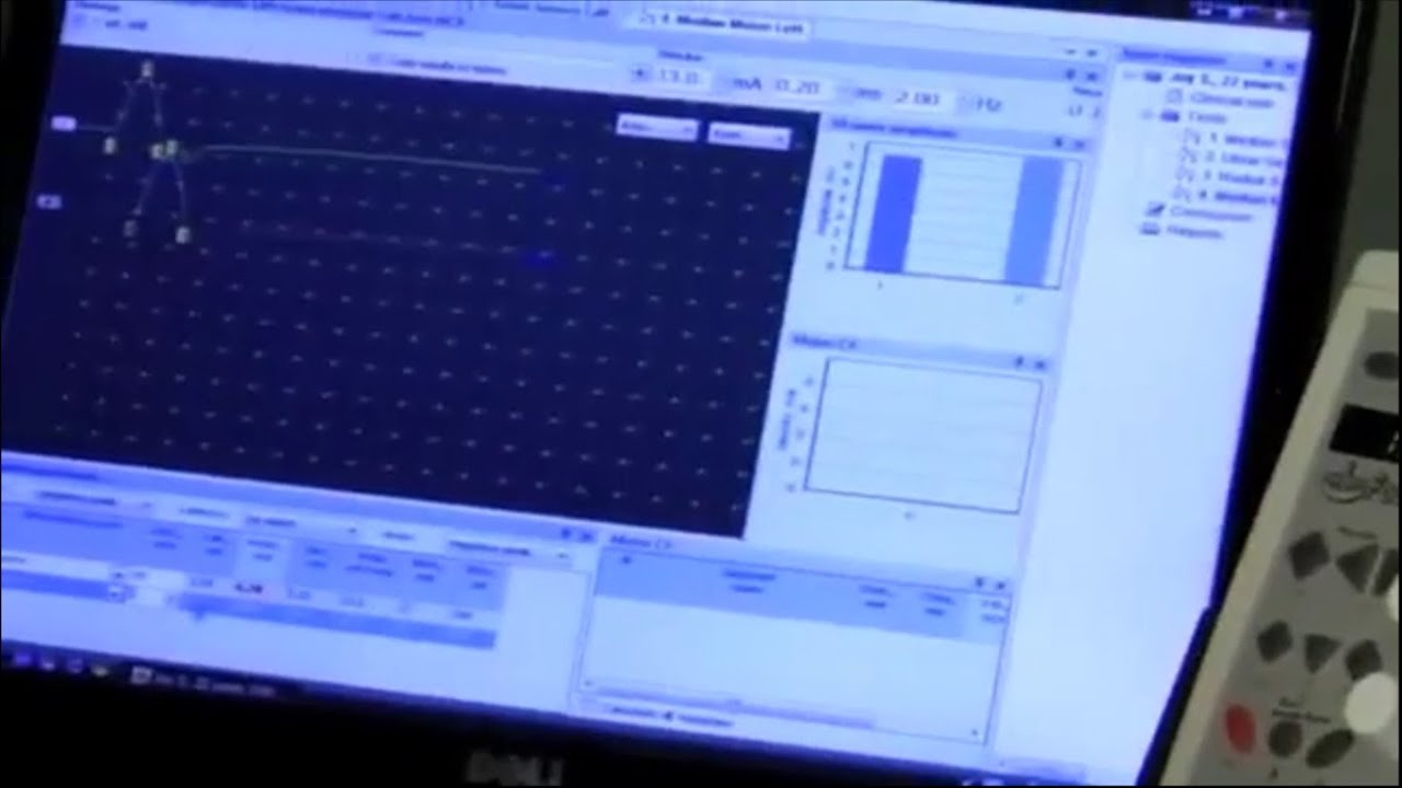 Chapter5 EDX - Median Sensory - Motor- F-Wave Nerve Conduction Study ...