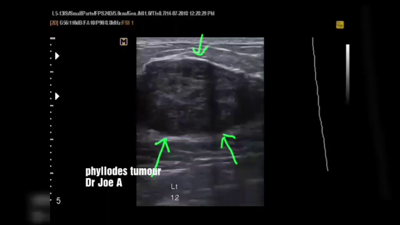 Phyllodes tumour breast 3D and 4D ultrasound - YouTube