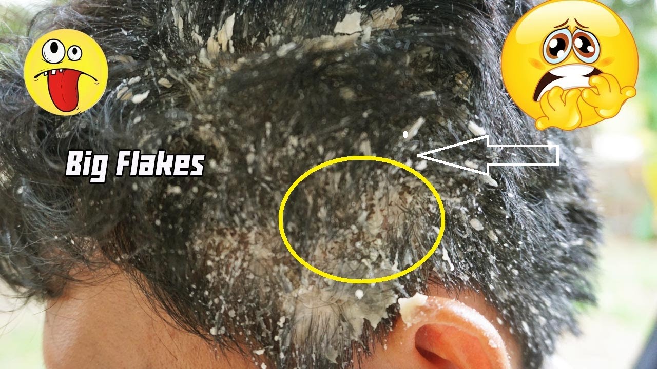 Huge Dandruff Flakes Removal on Back Side!! | Really Big Dandruff ...