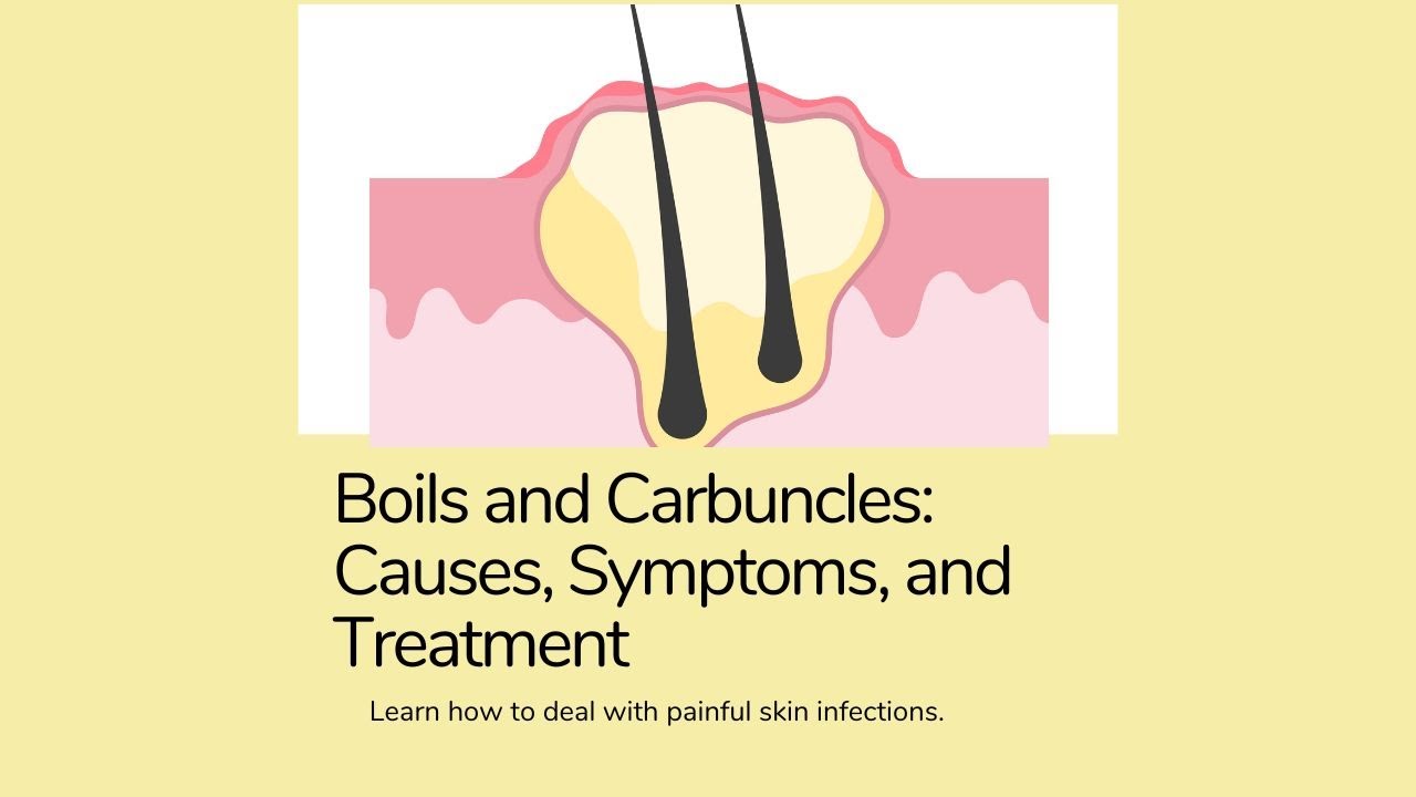 Boils and Carbuncles: Mind Map - YouTube