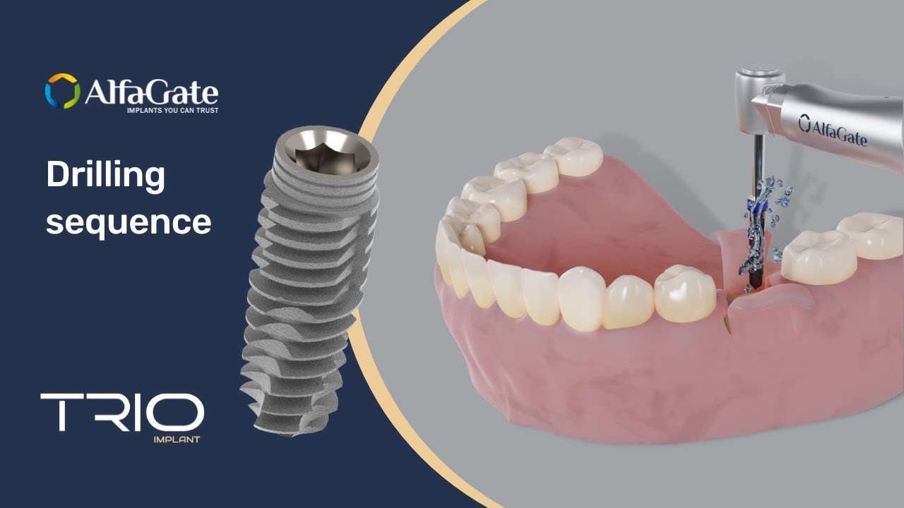 How to place Trio dental implant drilling sequence | Alfa Gate - YouTube