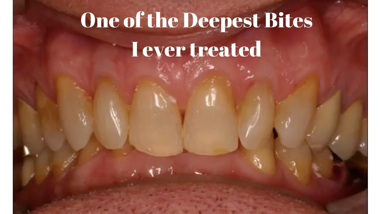One of the Deepest Bite cases I ever solved - YouTube