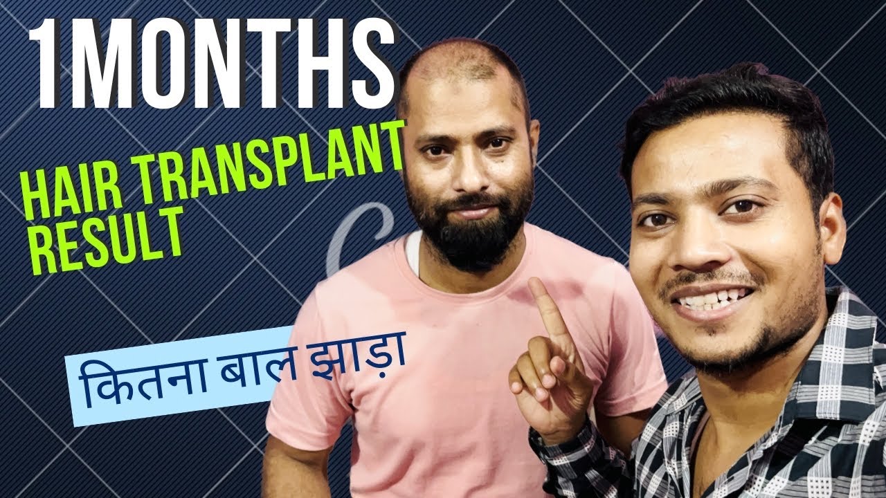 Hair Transplant Timelapse Day 1 To Day 30 1 Months Hair Transplant