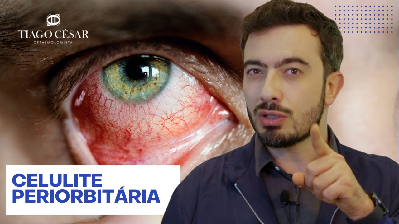 CELULITE PERIORBITÁRIA - Infecção Bacteriana que requer atenção | Dr ...