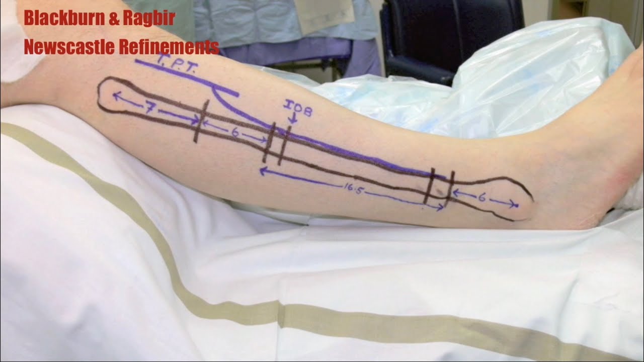 The free fibula flap for mandibular reconstruction - YouTube
