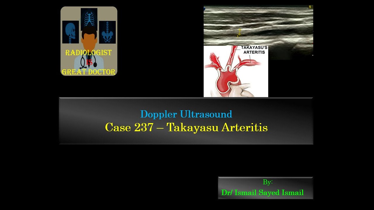 Ultrasound Case 237 - Takayasu Arteritis - YouTube