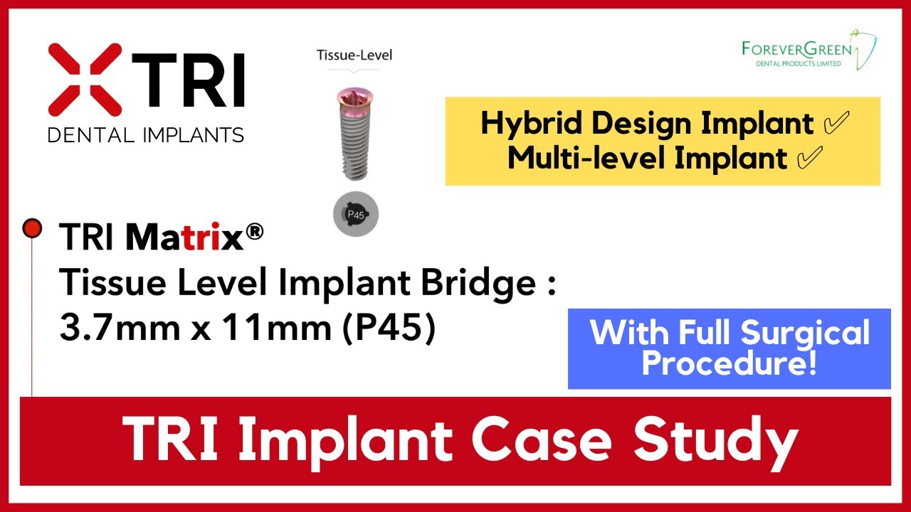 TRI Matrix® Implant Bridge Case Study (3.7mm x 11mm x P45) - Updated ...