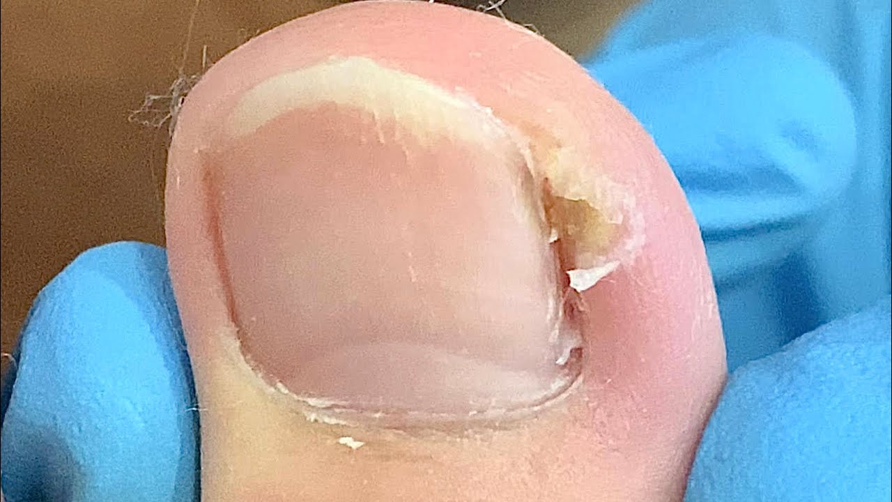 Trim long toenails & gentle pedicure【TD Foot care】 - YouTube