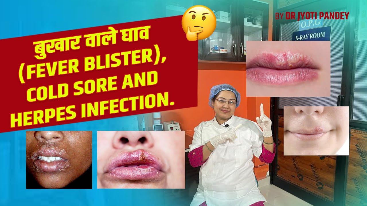 बुखार वाले घाव (Fever Blister), Cold sore and Herpes infection. - YouTube