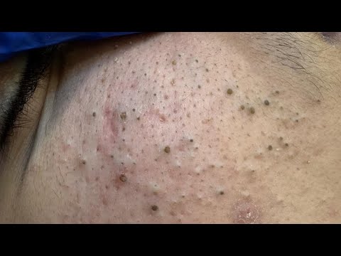 Deep Facial Cleansing | Acne Treatment & Pore Minimization Routine