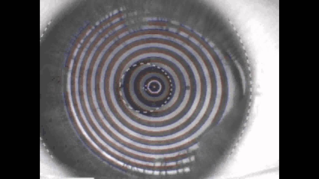 Femtosecond laser-assisted LASIK - Video abstract: 23573 - YouTube