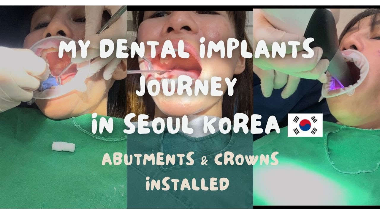 DENTAL SURGERY PART 2 in SOUTH KOREA | THE FINALE | ABUTMENTS AND ...
