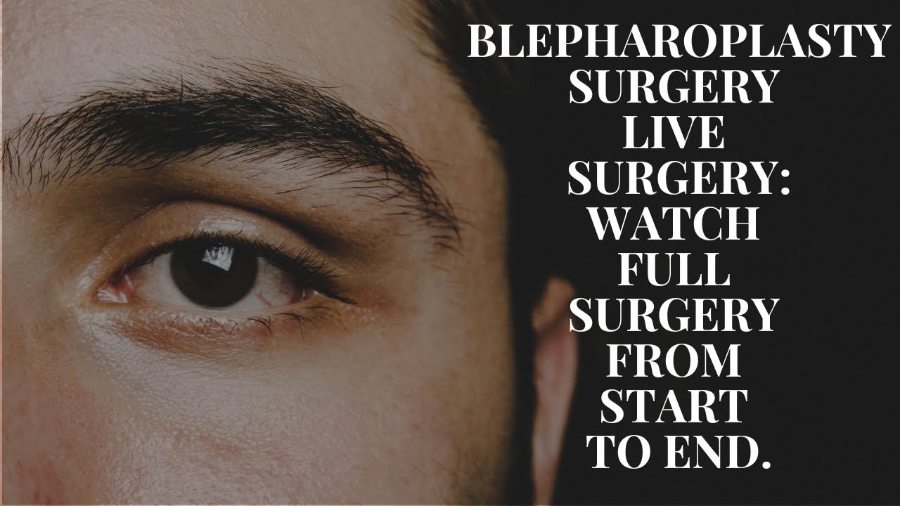 Blepharoplasty Surgery Live Surgery: Watch full surgery from start to ...