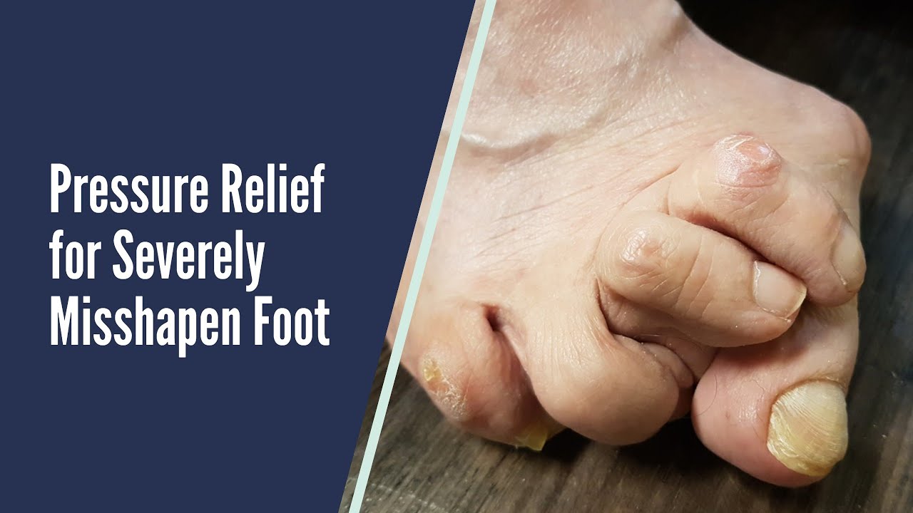 BALL OF FOOT PRESSURE RELIEF FOR SEVERELY MISSHAPEN FOOT - YouTube
