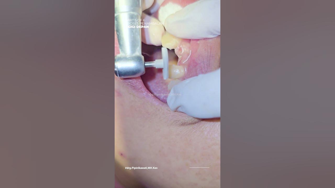 PROSES PENAMBALAN DUA GIGI GERAHAM || PART 5 OF 6 - YouTube