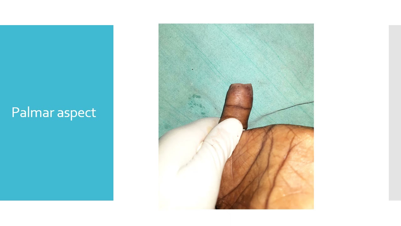 MOBERG ADVANCEMENT FLAP FOR THUMB TIP DEFECT VIDEO - YouTube